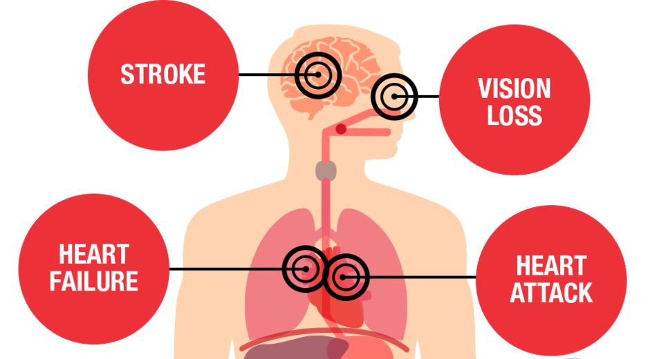 Health Threats From High Blood Pressure American Heart Association health-threats-from-high-blood-pressure-american-heart-association